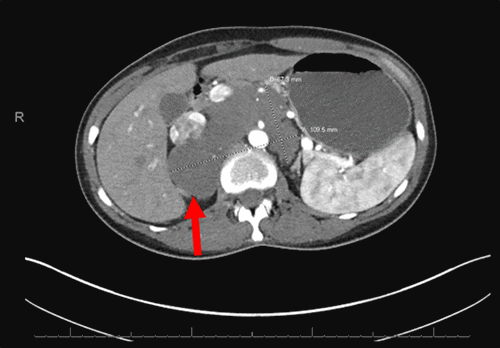 Large Retroperitoneal Ganglioneuroma with Extensive Vascular and ...