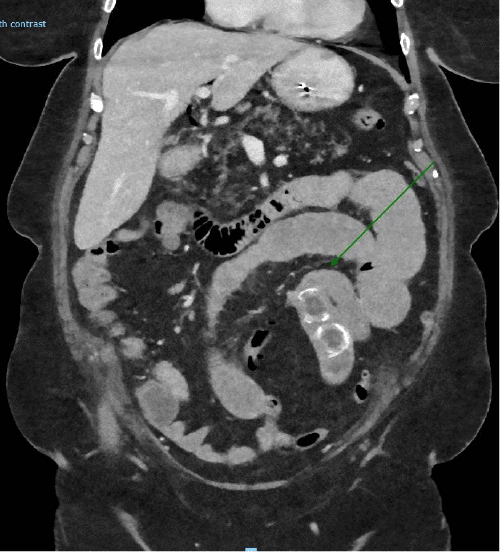 A Rare Case of Recurrent Gallstone Ileus | ACS