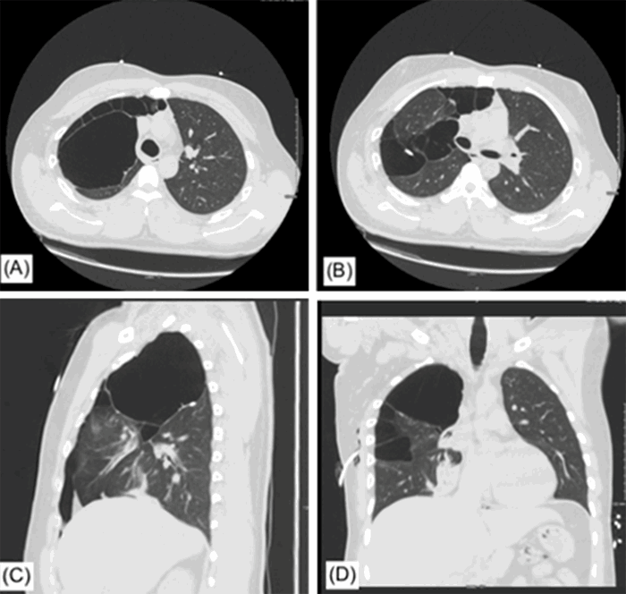 The “Big Hit of Vape” That Led to a Pneumothorax | ACS