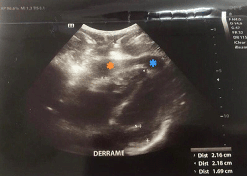 Not All Hemopericardium Requires Opening the Chest | ACS