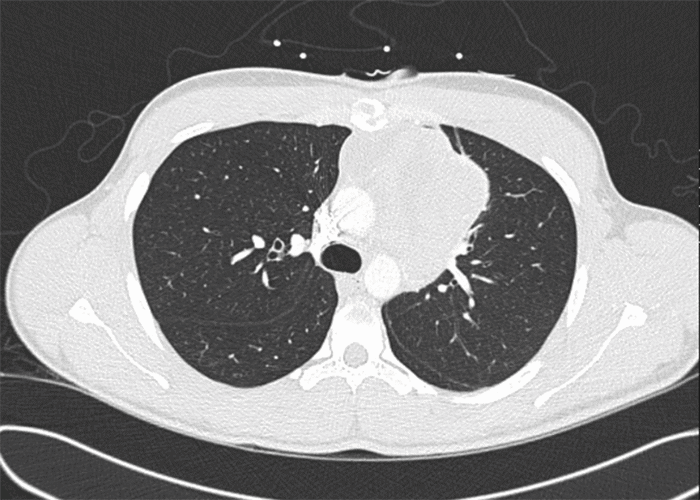 The Chamberlain Procedure to Diagnose Primary Mediastinal Seminoma ...