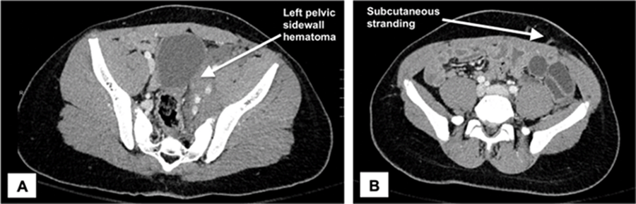 Handlebar Hernia: The Need for High Clinical Suspicion | ACS