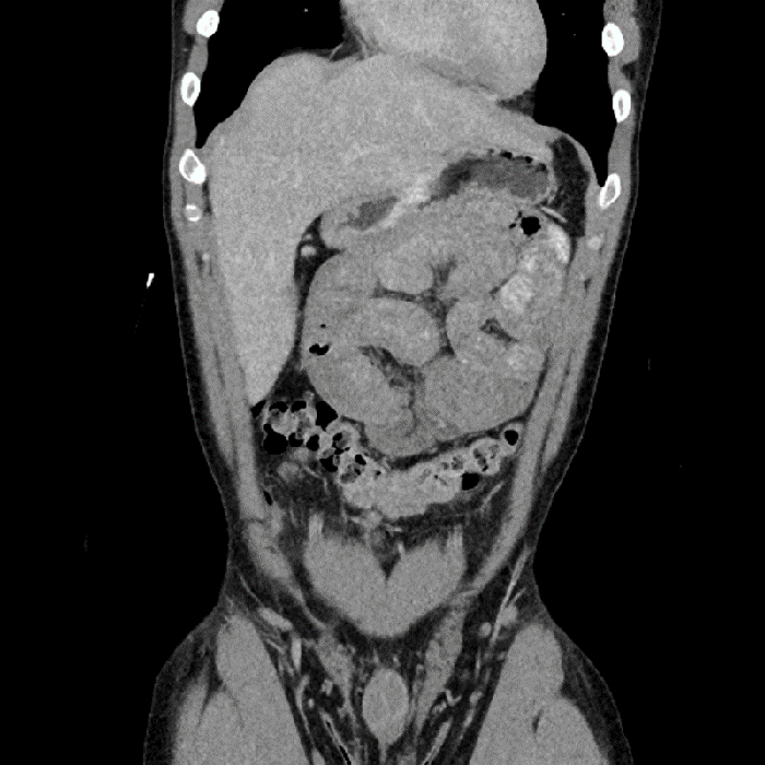 Hemorrhagic Cholecystitis | ACS
