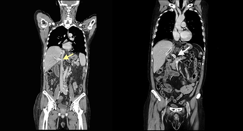 Successful Use of Double ePTFE Graft for Inflow and Outflow ...