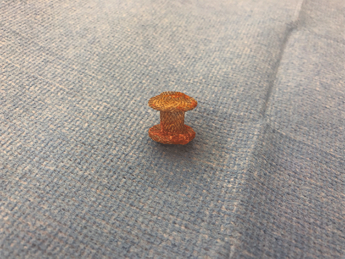 The Poppy Seed Test for Enterovesical Fistula | ACS