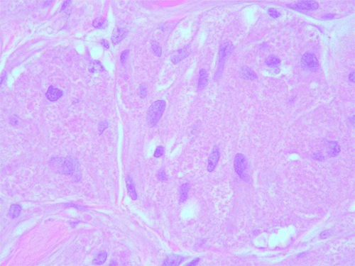 Granular Cell Tumor of the Cecum: A Rare Neoplasm | ACS