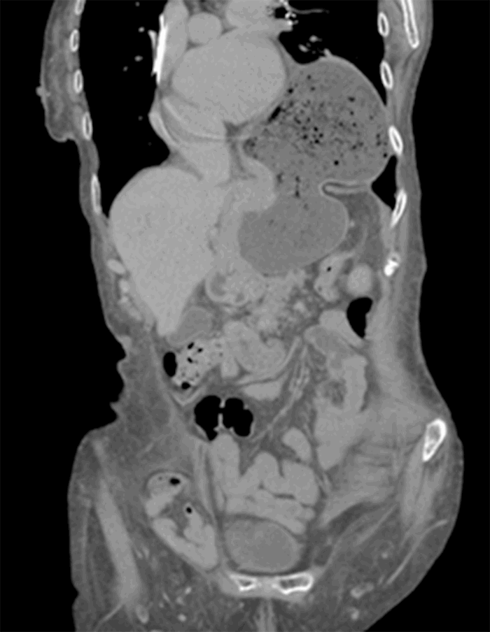 Endoscopic Management of a Type III Paraesophageal Hernia Causing ...
