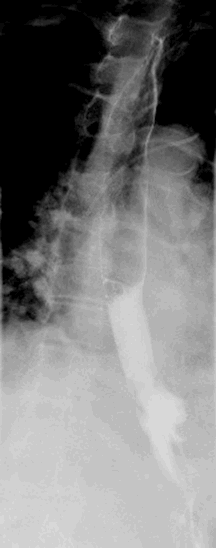 Successful Use of Endoscopic Vacuum-Assisted Closure for Mediastinal ...