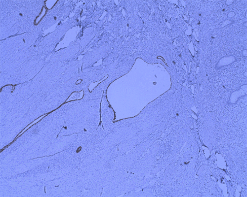 Intussusception of the Appendix Secondary to Endometriosis | ACS