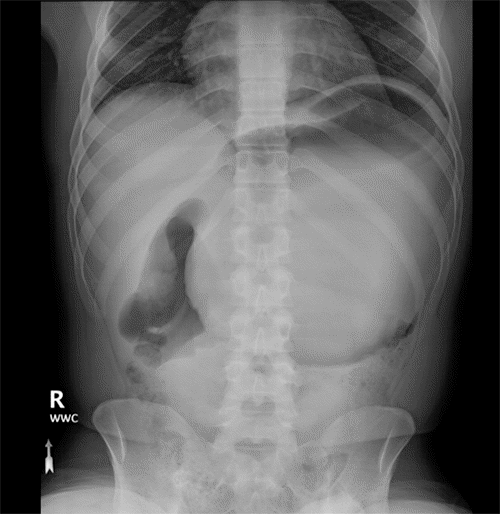 Perforated Gastric Volvulus in a Patient with Prior Surgery for ...