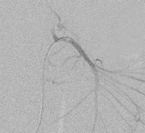 The Evolution of REBOA: Successful Use of Resuscitative Endovascular ...