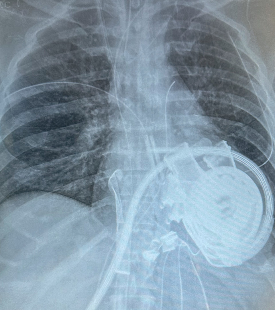 With “Real Momentum,” Total Artificial Heart Technology Faces Defining ...