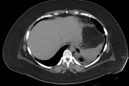 A Minimally Invasive Approach to Persistent Gastric Staple-Line Failure ...