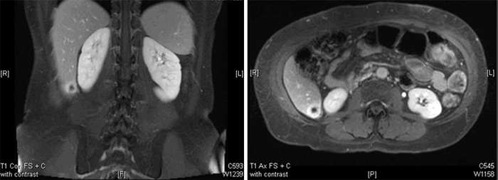 Retained Gallstone Presenting as Hepatic Mass | ACS
