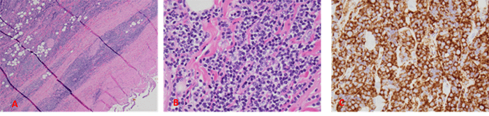 Non-Hodgkin Lymphoma Involving the Gallbladder | ACS
