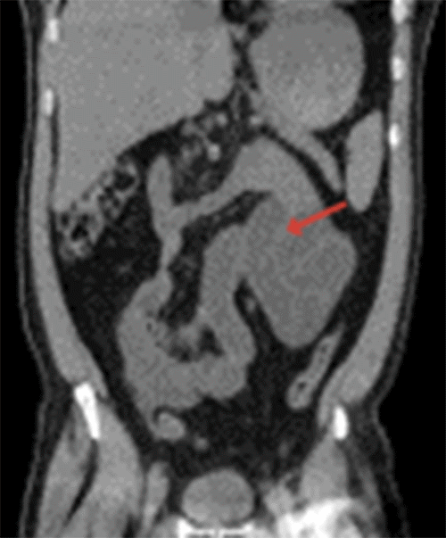Omental Flap as a Novel Alternative Technique for Closure of a Left ...