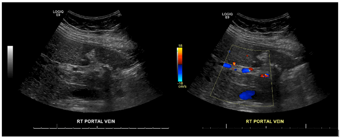 Extensive Portomesenteric Venous Thrombosis after Laparoscopic Sleeve ...