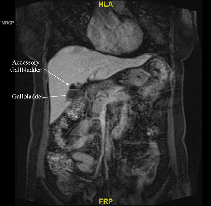 Indocyanine Green Fluorescence-Guided Laparoscopic Cholecystectomy with ...