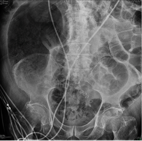 Cecal Bascule Following a Small Bowel Resection for Meckel’s ...
