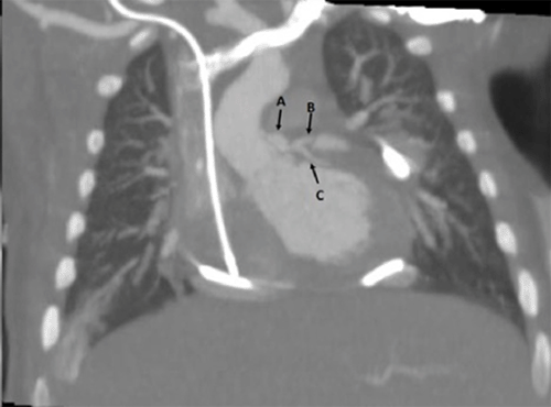 Atrial Appendage Tissue as Autologous Vascular Conduit in Pediatric ...