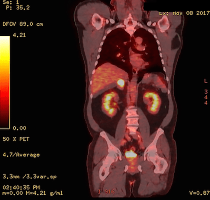 An Uncommon Presentation of FDG-PET Avid Papillary Thyroid Carcinoma ...
