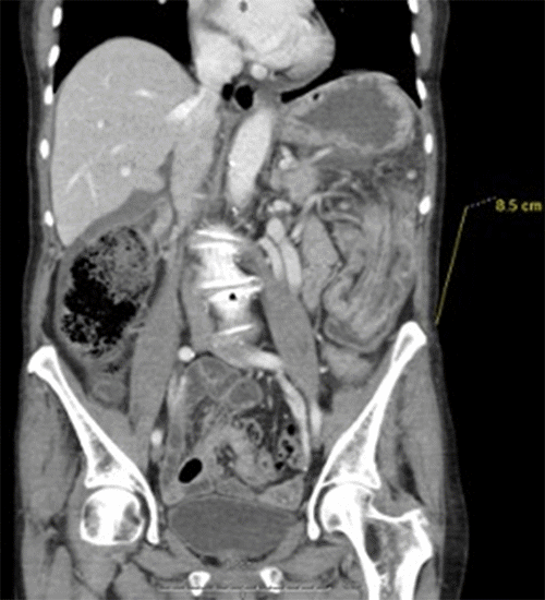 Surgical Intervention for Rapidly Progressing Obstruction Identified in ...