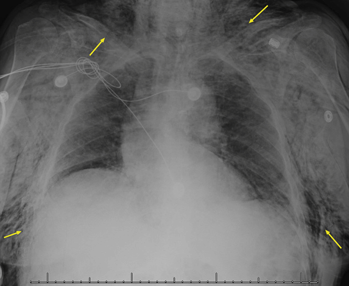 Traumatic Lung Herniation, Repair With Rib Fixation | ACS