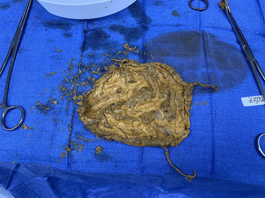 Complete Mesh Migration Into the Small Bowel Following Parastomal ...