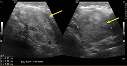 Antepartum Thyroidectomy for Retrosternal Thyroid Goiter | ACS