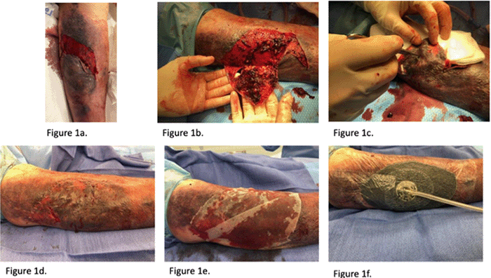 A Novel Technique: In Situ Autologous Skin Graft to Manage Traumatic ...