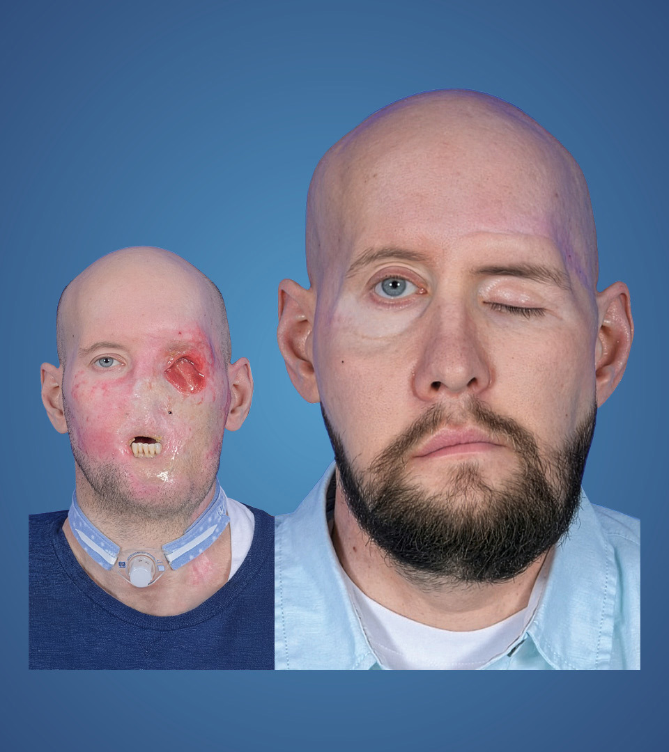 Facial Transplantation Pushes Beyond Limits of Reconstruction | ACS