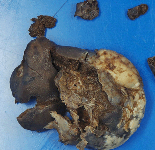 Incidentally Found Splenic Endometriosis During Laparoscopic ...