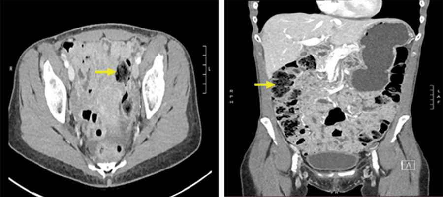 Rectosigmoid Intussusception as a Rare Manifestation of Colorectal ...