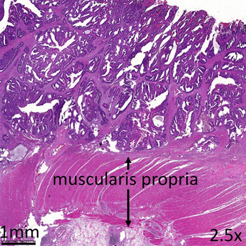 Rectosigmoid Intussusception as a Rare Manifestation of Colorectal ...