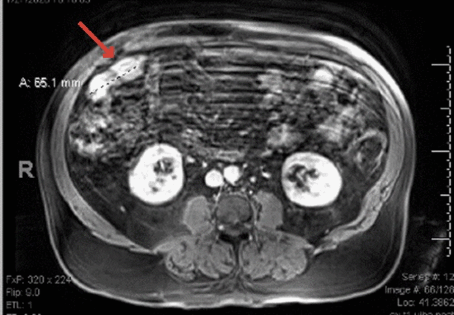 Small Bowel Resection of Inflammatory Fibroid Polyp Following Occult ...