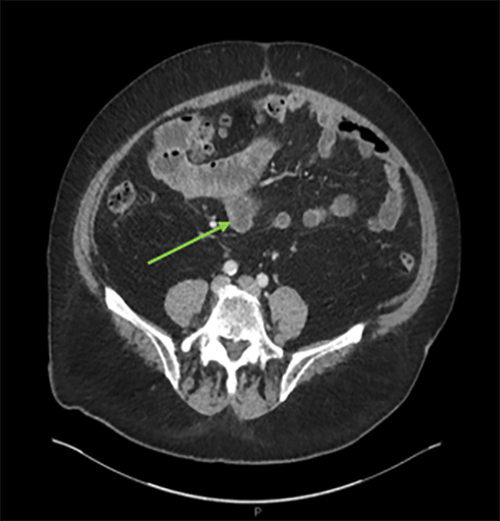 Cecal Bascule Following a Small Bowel Resection for Meckel’s ...