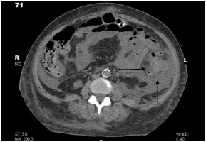 A Case of Complicated Clostridium difficile Infection (CDI) Treated ...