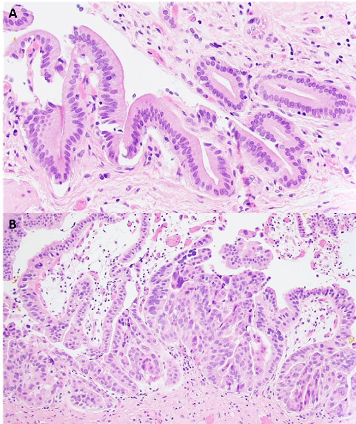 Giant Choledochal Cyst Presenting With Biliary Obstruction Without ...
