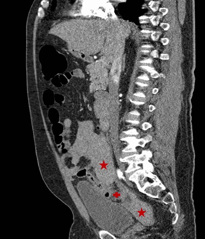 Spontaneous Hemoperitoneum in Sigmoid Diverticular Disease | ACS