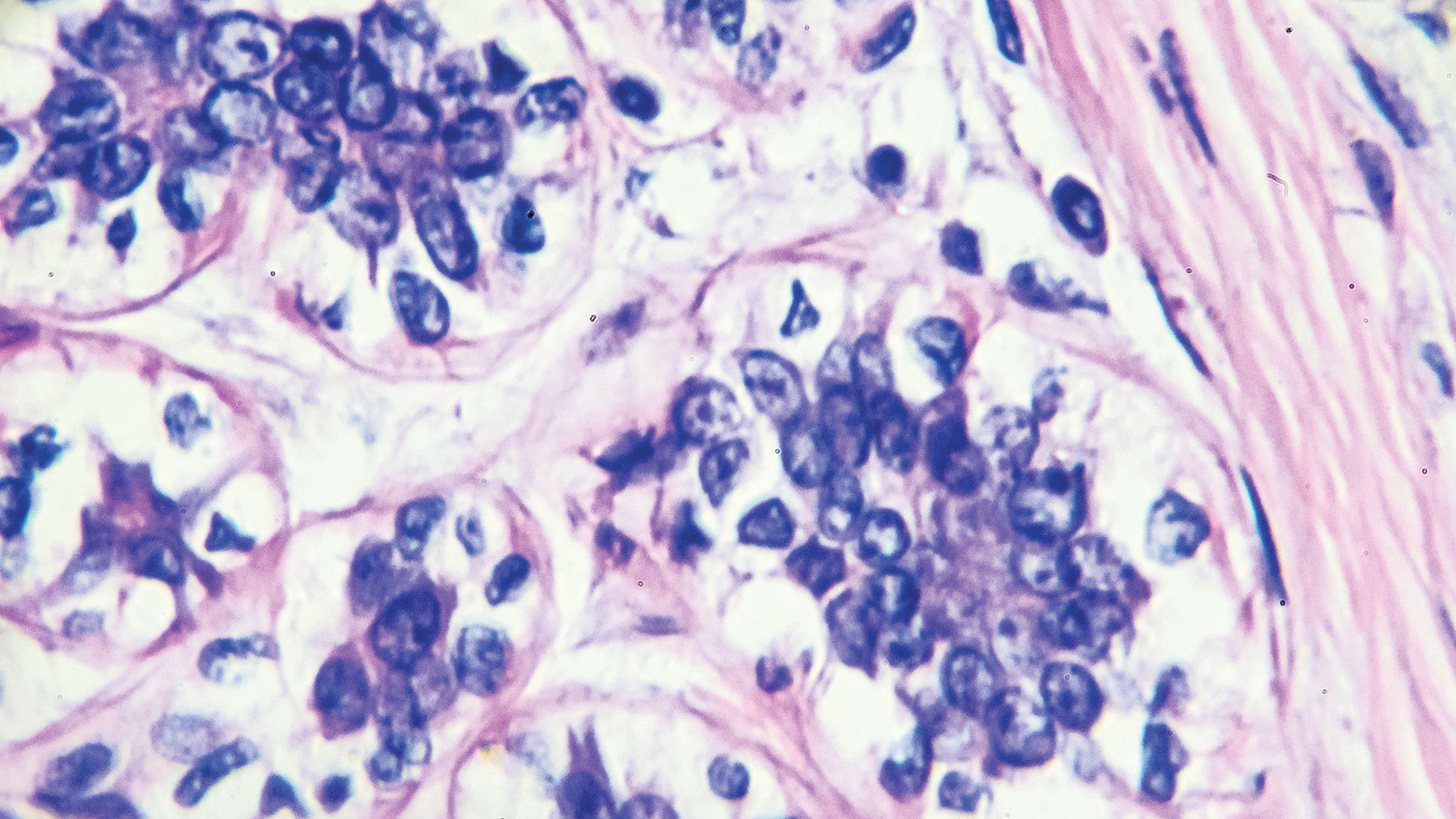 ACS Awards Help Surgeon-Scientist Build a Sustainable Breast Cancer ...