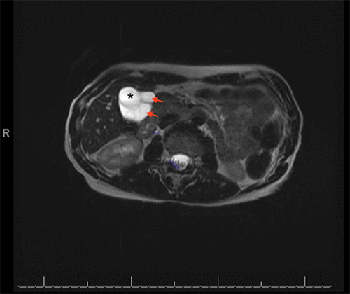Cystic Lymphangioma of the Gallbladder in a 47-Year-Old Woman | ACS