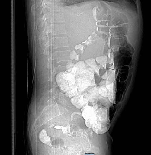 Acute Tip Appendicitis in the Setting of Newly Diagnosed Adult T-Cell ...