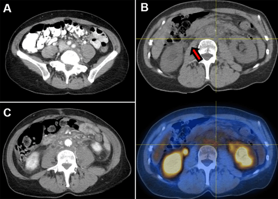 Retroperitoneal Fibrosis: A Harbinger of Metastatic Gastric ...