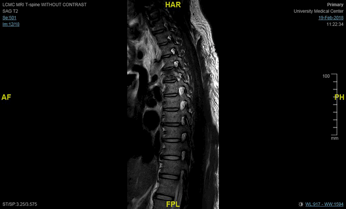 Penetrating Chest Trauma from a Crossbow Injury | ACS