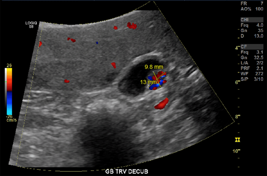 Presentation, Imaging, and Management of a Rare Case of Paraganglioma ...