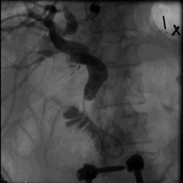 Diagnostic and Surgical Challenges of an Obstructing Bile Duct Neuroma ...