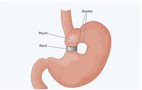 Gastrogastric Fistula Following Vertical Banded Gastroplasty Treated ...