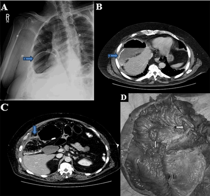 Chilaiditi’s Sign and the Acute Abdomen | ACS