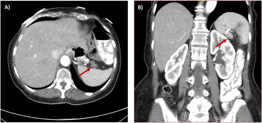 Peritoneal Recurrence of Early-Stage Gastric Cancer With Associated ...