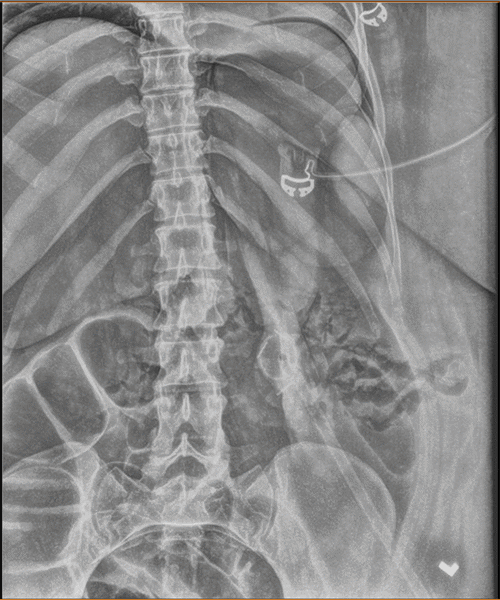 Tension Pneumoperitoneum after Percutaneous Endoscopic Gastrostomy Tube ...